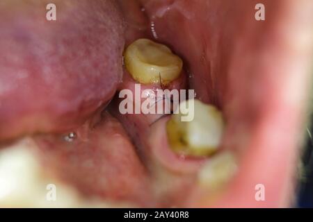 Jaw after tooth extraction, sutured tissue Stock Photo - Alamy