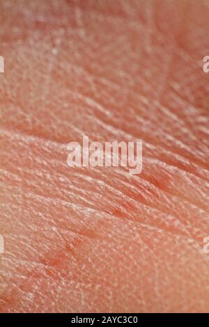 Skin close up. Dry human skin under microscope with eczema damage ...