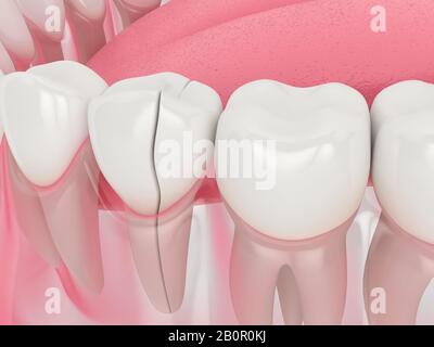 3d render of jaw with split tooth over white background. Types of ...