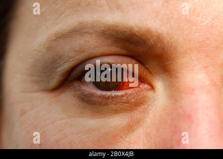 Eye infection. Close-up of an eye affected by viral conjunctivitis. The ...