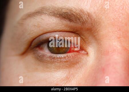 Eye infection. Close-up of an eye affected by viral conjunctivitis. The ...