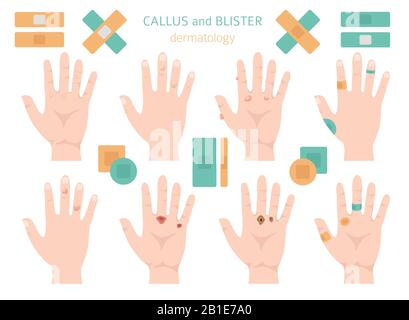 Callus, corn and blister feet and hands. Dermatology. Medical desease ...
