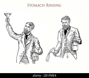 Lavage of the stomach. Illustration of the 19th century. Germany. White ...