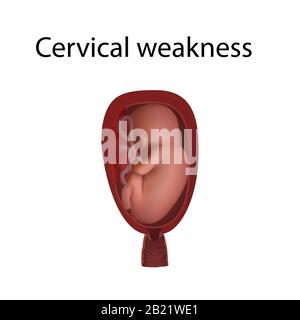 Cervical weakness complications, illustration Stock Photo - Alamy