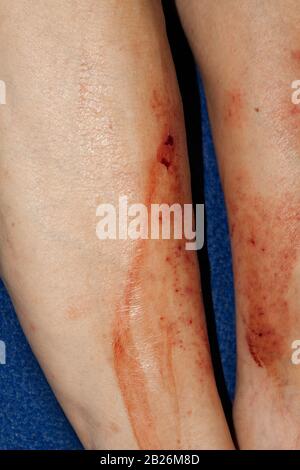 Bloody scratched due to massive itching, Neurodermatitis respectively ...