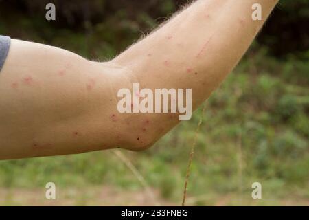 white man showing his arm with hives marks due to mosquito bites Stock ...