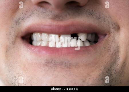 Man with missing front tooth Stock Photo - Alamy
