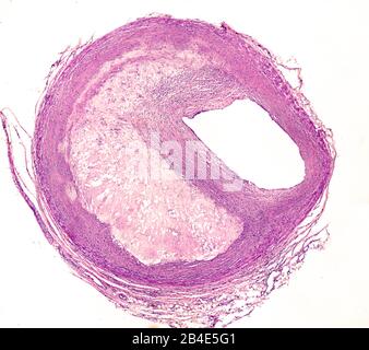 Artery showing Atheroma Stock Photo - Alamy