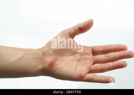 the scratch wound on female hand closeup, healthcare and medicine ...
