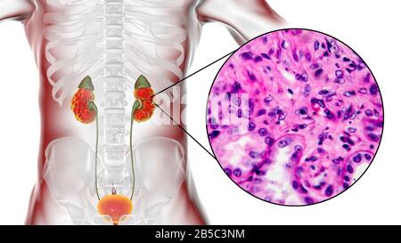 Chronic pyelonephritis, illustration and light micrograph Stock Photo ...