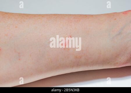 atopic dermatitis symptom skin on hand Stock Photo - Alamy