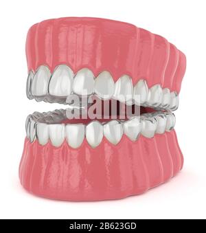 3d render of jaw with invisalign removable retainer with jaw over white ...