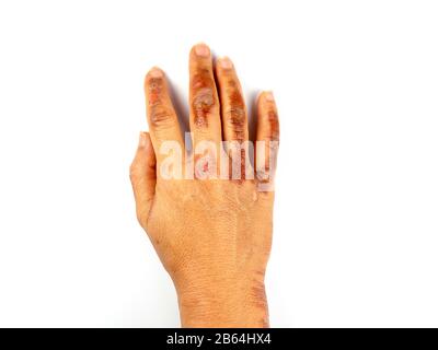 Horrible burns on female hand isolated on white Stock Photo - Alamy