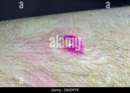 Papules on the skin of a patient with chickenpox close-up. Varicella ...