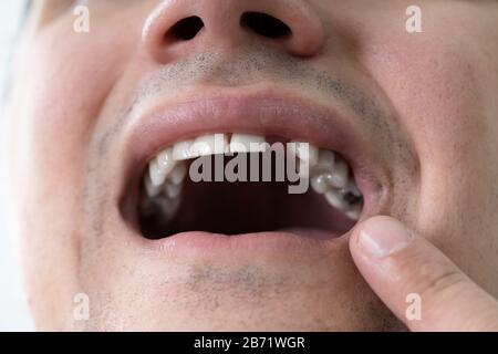 Man with missing front tooth Stock Photo - Alamy