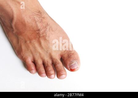 Ingrown toenail with dressing Stock Photo - Alamy