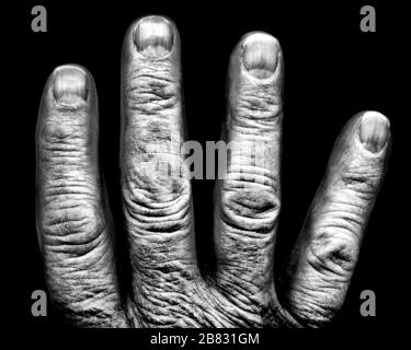 Man with only four fingers Stock Photo - Alamy