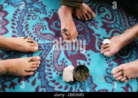 Kashmiri Muslim people receives leech therapy from a practitioner ...