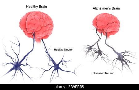 The Healthy Brain and The Unhealthy Brain Stock Photo - Alamy