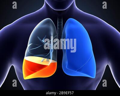 Medical illustration showing pneumonia in the alveolus of human lungs ...
