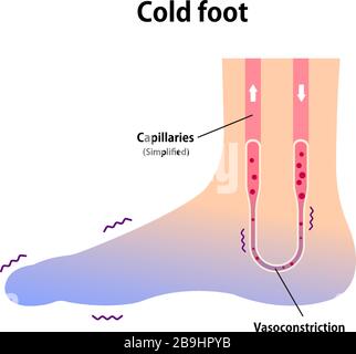 Cold foot blood circulation illustration (sensitivity to cold, cold ...