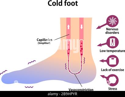 Cold foot blood circulation illustration (sensitivity to cold, cold ...