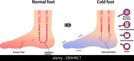 Comparison illustration of normal foot and cold foot ( sensitivity to ...