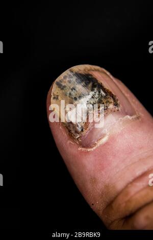 Onycholysis, Detachment Of Nail From Nailbed Stock Photo - Alamy