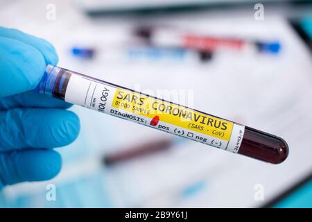 Fictional Blood samples with infected SARS coronavirus, with ...