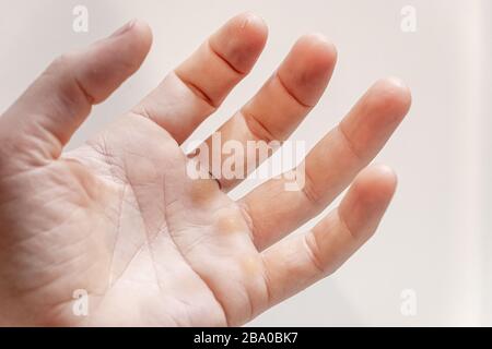 On hand finger there is blister callus with dry skin and trauma on hand ...