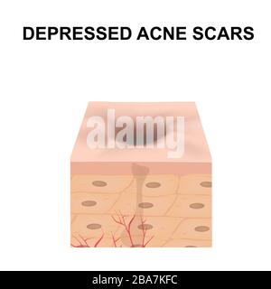 Types of scars. Acne scars. Keloid, hypertrophic, atrophic ...
