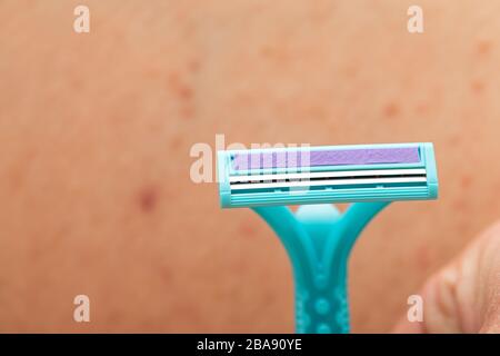 Close up picture of painful folliculitis on female leg. Shaving ...