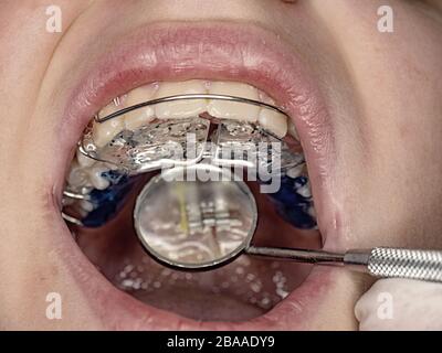 Methods of Teeth Correction Stock Photo - Alamy