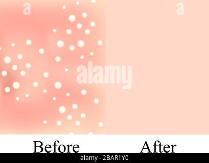 Skin texture with black dots of acne. Before After acne. Skin ...