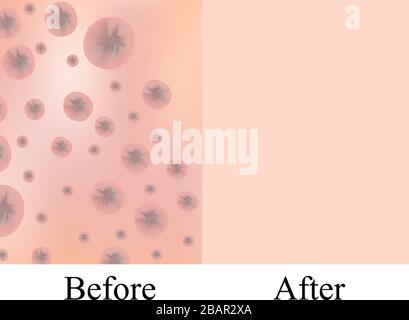 Texture with acne scars and acne. Before After scar cysts. Skin ...