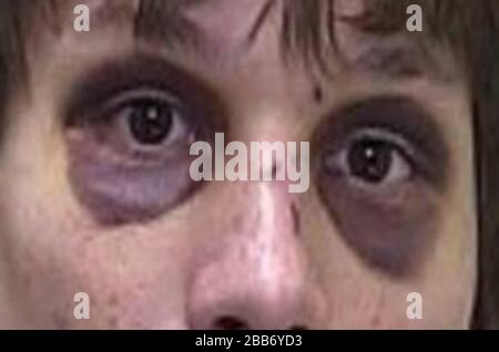 . English: Bilateral periorbital ecchymosis also known as 'raccoon eyes ...