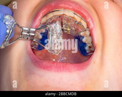 Doctor check retainer orthodontic correction in mouth. Methods of Teeth ...