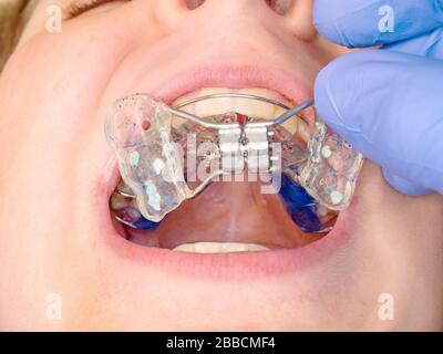 Palatal expander for the maxilla. The removable orthodontic appliance ...