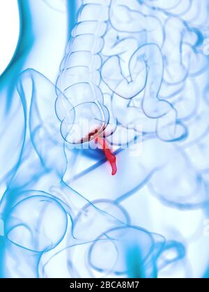 Appendicitis disease or vermiform appendix inflammation 3D rendering ...