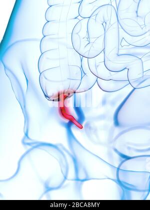 Appendicitis disease or vermiform appendix inflammation 3D rendering ...