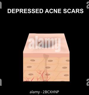 Types of scars. Acne scars. Keloid, hypertrophic, atrophic ...