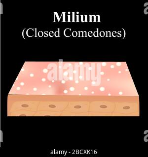 Closed comedones. Acne on the skin. Dermatological and cosmetic ...