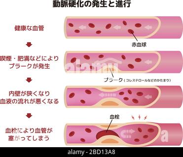 Atherosclerosis progression of an illness illustration Stock Vector ...