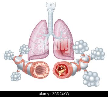 Diagram showing Asthma, normal and asthmatic airways, medically ...