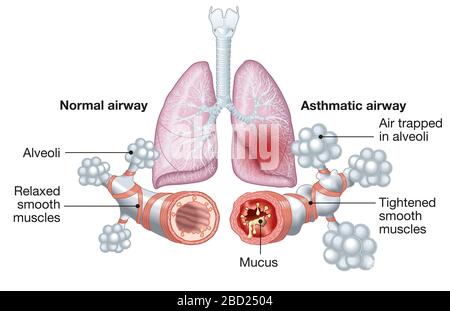 Diagram showing Asthma, normal and asthmatic airways, medically ...