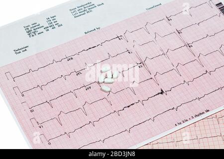 Close Up Echocardiograph test report (ECG) showing abnormal heart ...