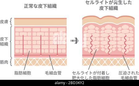 skin with cellulite and normal skin cross-section of human skin layers ...