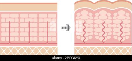 Comparative illustration of normal skin and cellulite's skin Stock ...