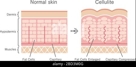 skin with cellulite and normal skin cross-section of human skin layers ...