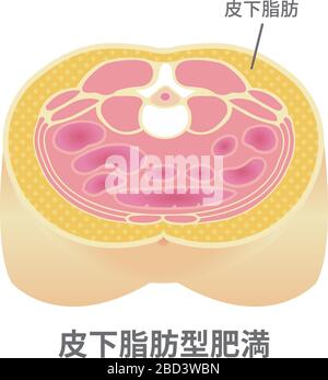 Type of obesity illustration. Abdominal sectional View. (visceral fat ...